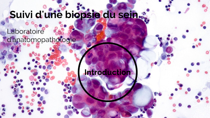 Suivi d'un prélèvement de biopsie du sein by Emy Doe on Prezi