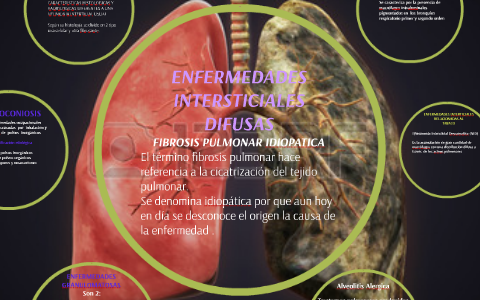FIBROSIS PULMONAR IDIOPATICA by bryan castillo bejarano on Prezi