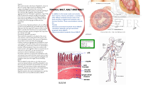 TONSILS BALT GALT AND MALT by paula weinberger on Prezi