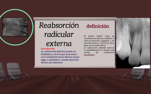 Reabsorción radicular externa by Beatriz Sinchi on Prezi