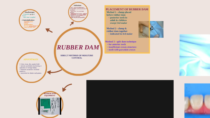 RUBBER DAM by norsyafikah jamaludin on Prezi