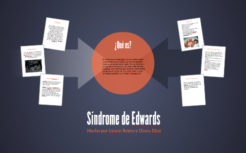 Síndrome de Edwards - Trisomía 18 by Diana Diaz on Prezi