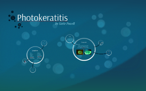 Photokeratitis by Katie Powell on Prezi