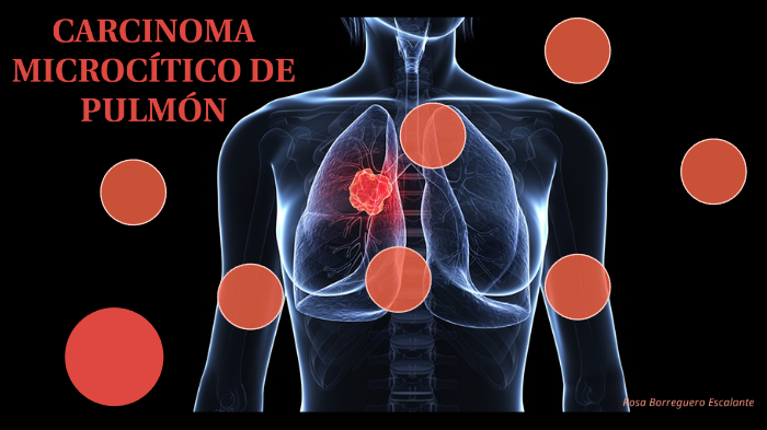 Carcinoma microcítico de pulmón by Rosa Borreguero Escalante on Prezi