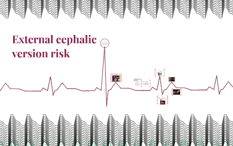 External cephalic version risks by Pamela Alvarez on Prezi