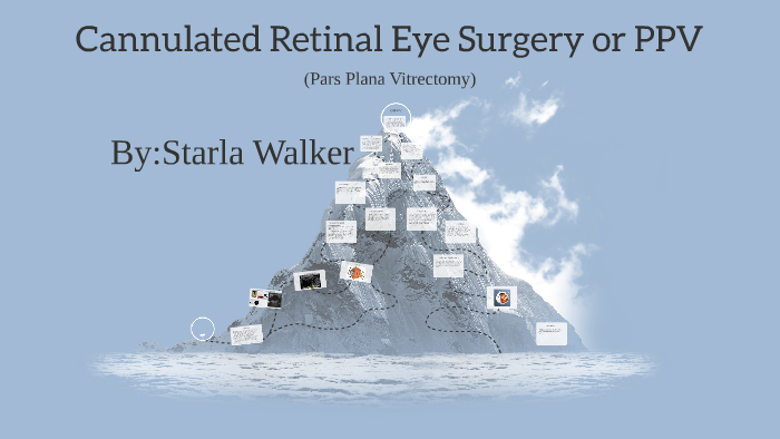 CannulatedRetinal Eye Surgery or PPV by Starla Walker on Prezi