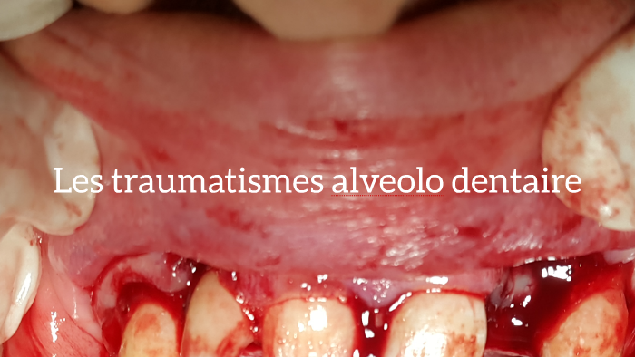 Les traumatismes alveolo dentaire by Saoussene Hs on Prezi