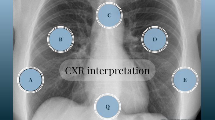 CXR interpretation by SCP Radiology on Prezi