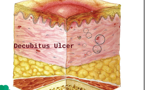 Decubitus Ulcer by Jasmine Jacobo on Prezi