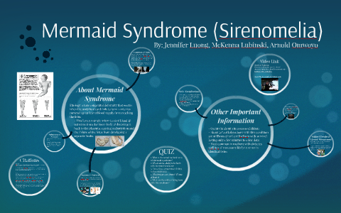 Mermaid Syndrome (Sirenomelia) by Jennifer Luong on Prezi
