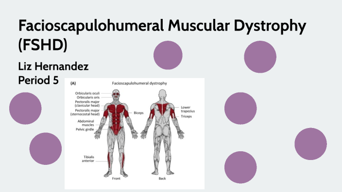 Facioscapulohumeral Muscular Dystrophy- Liz Hernandez by Lizbeth ...
