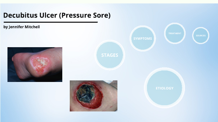 Decubitus Ulcers by Jenny Mitchell on Prezi