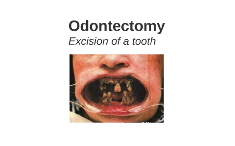Odontectomy by Ty Galloway on Prezi