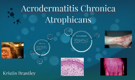 Acrodermatitis Chronica Atrophicans by Kristin Brantley on Prezi